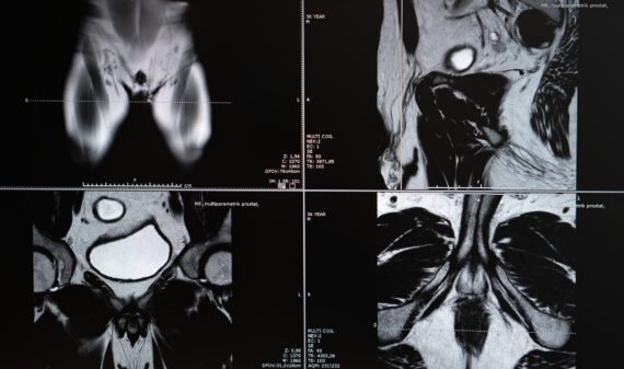 KOELIS Trinity® Fusion Biopsy - UCI Prostate Cancer Center | Prostate ...